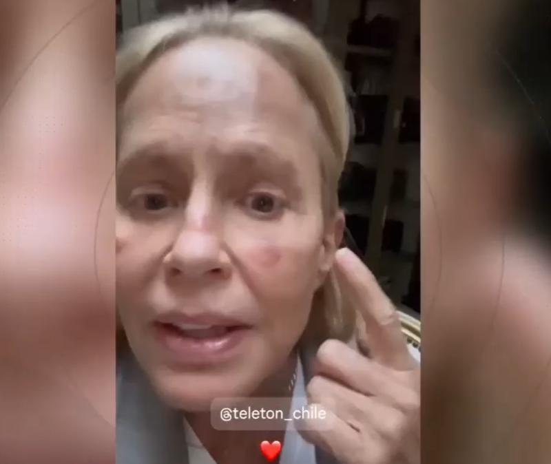 Dejó registro de sus lesiones: Cecilia Bolocco se baja de la Teletón por problemas de salud | 13.cl